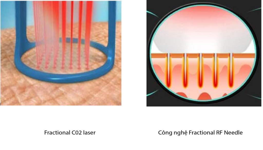 So sánh Công nghệ RF Fractional và Laser CO2 Fractional - Máy Thẩm Mỹ HPMED